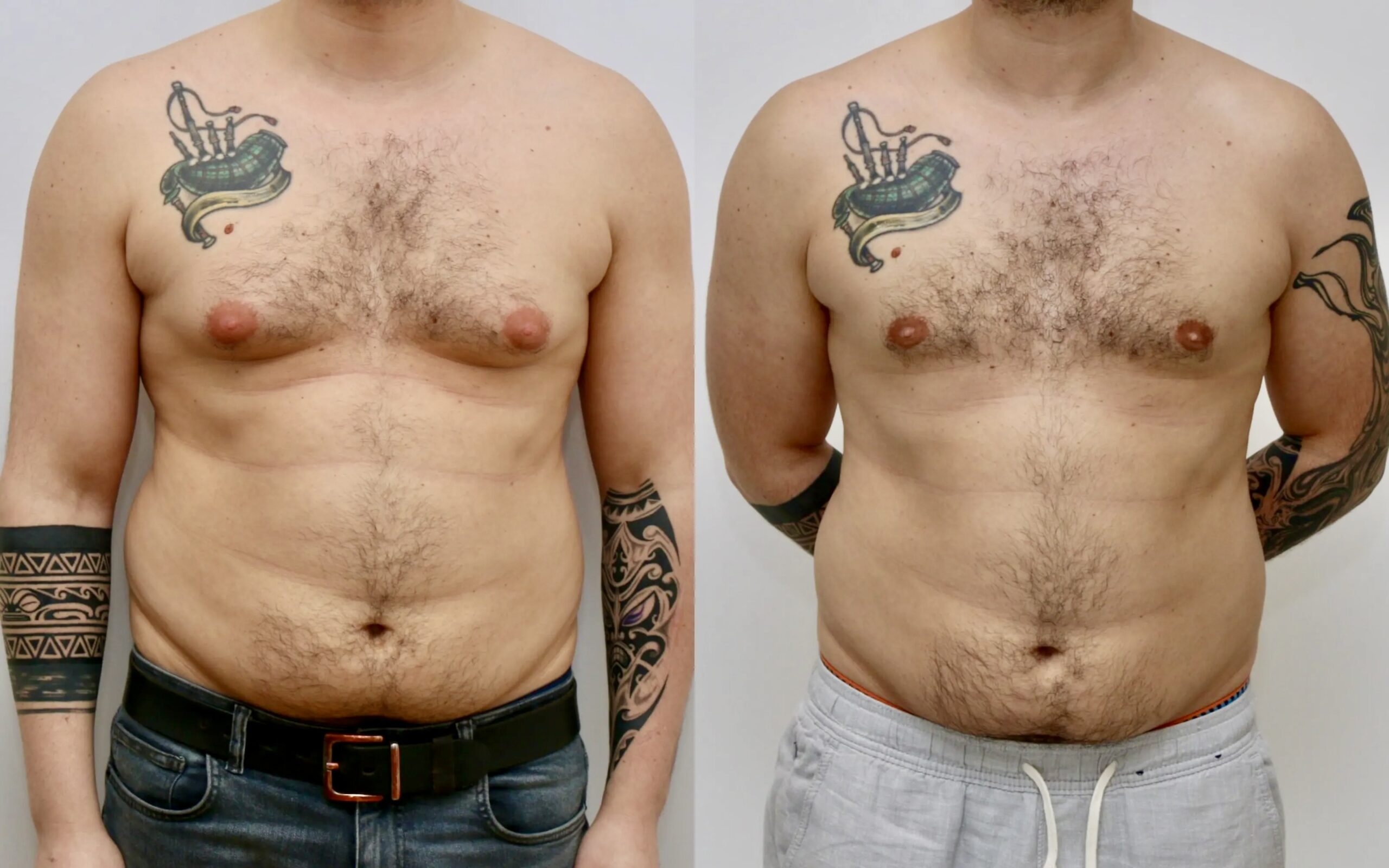 Gynecomastia Surgery Male Breast Reduction Edinburgh