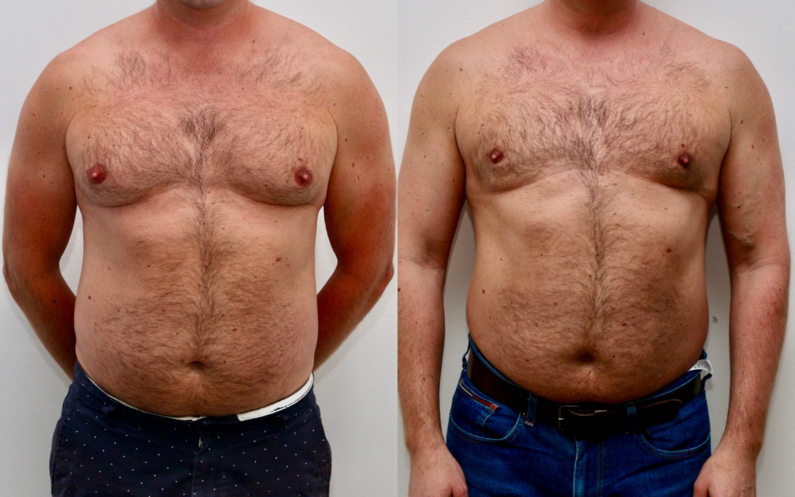 Gynecomastia Surgery Male Breast Reduction Edinburgh