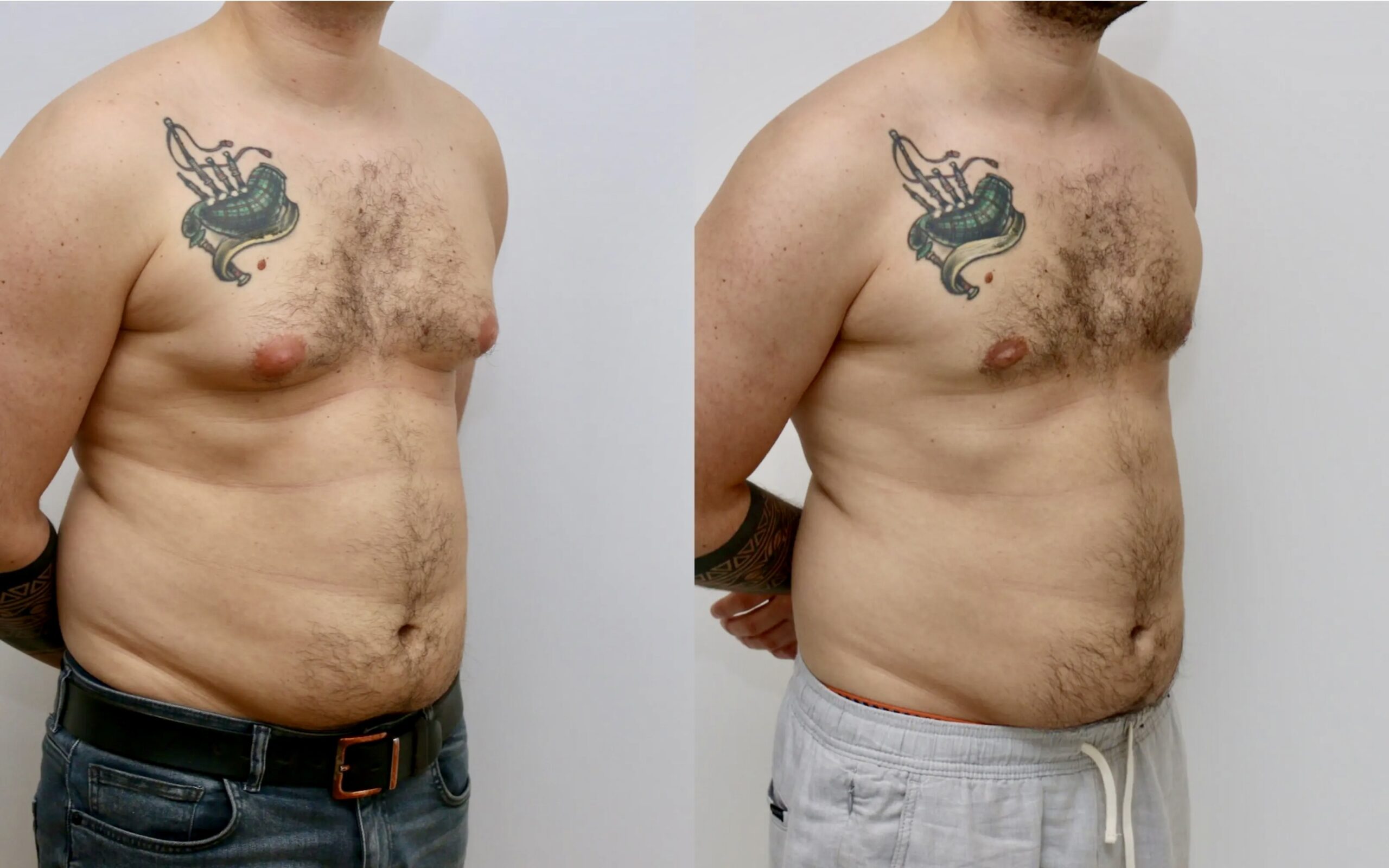 Gynecomastia Surgery Male Breast Reduction Edinburgh