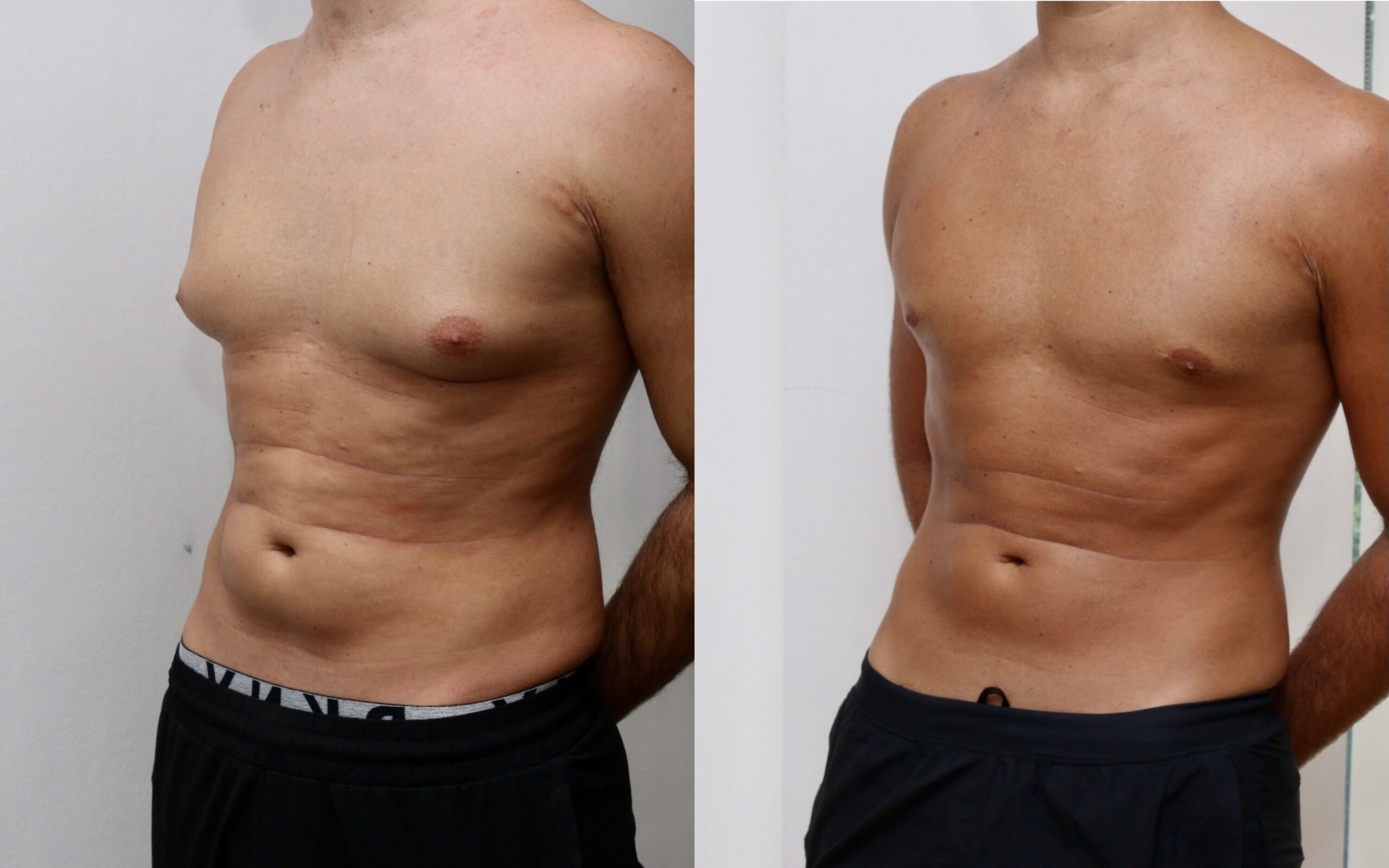 Gynecomastia Surgery Male Breast Reduction Edinburgh