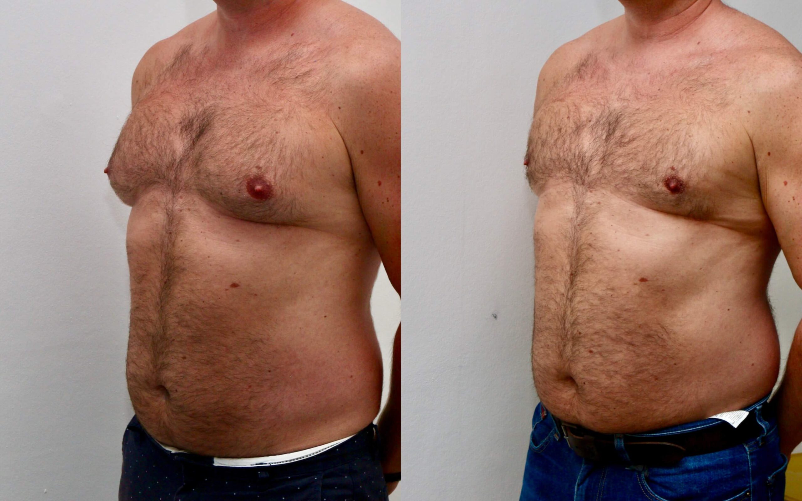 Gynecomastia Surgery Male Breast Reduction Edinburgh