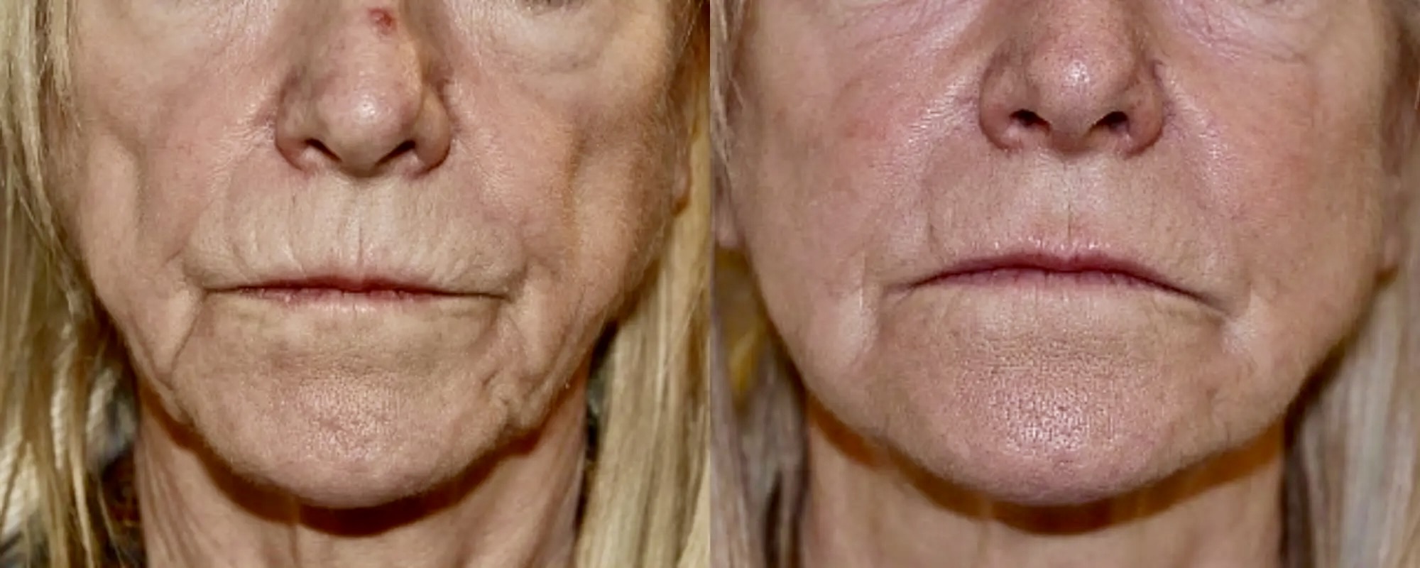 Dermal Fillers at Waterfront Hospital Edinburgh