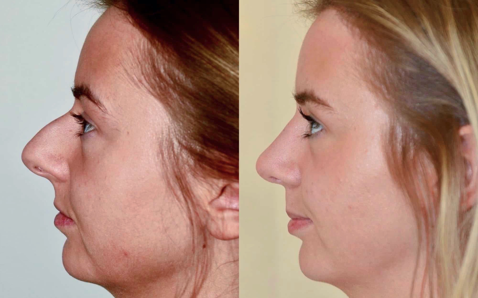 Rhinoplasty Experts in Edinburgh | Transform Your Profile