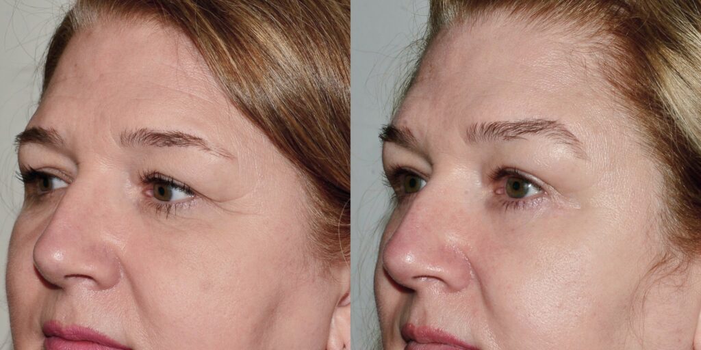 Brow Lift Surgery Edinburgh | Look More Alert